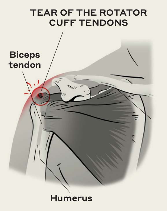 Here's what to do when shoulder pain strikes on the course